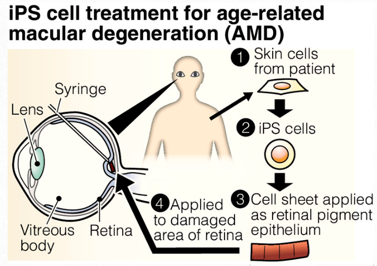 IPS Cell Treatment For Age related Macular Degeneration AMD 